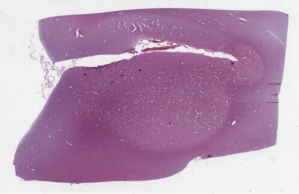 Digital Slide Viewer: neuropathology\Vascular