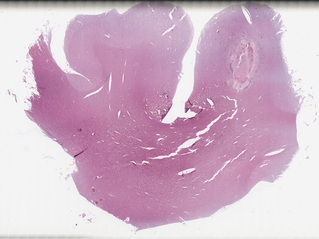 Digital Slide Viewer: neuropathology\Vascular