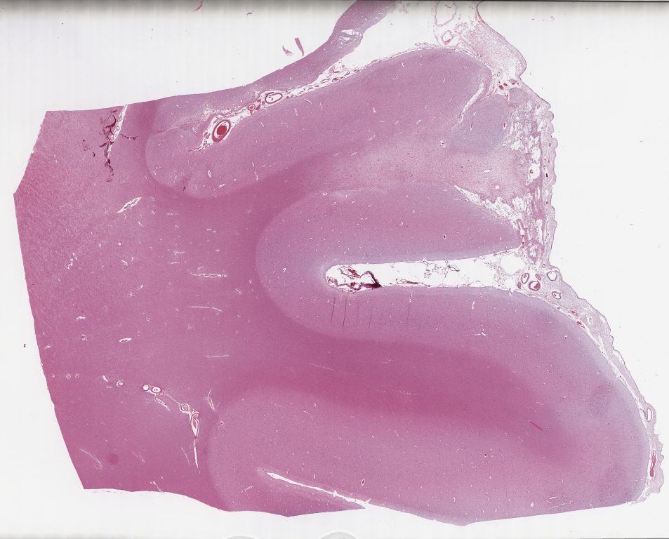 Digital Slide Viewer: neuropathology\Vascular