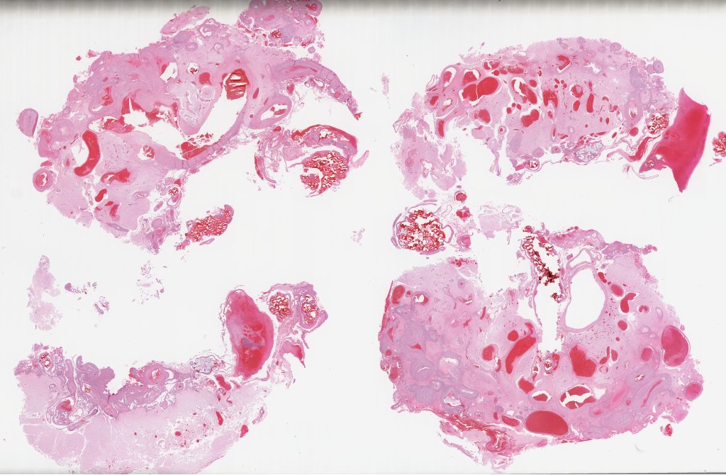 Digital Slide Viewer: neuropathology\Vascular