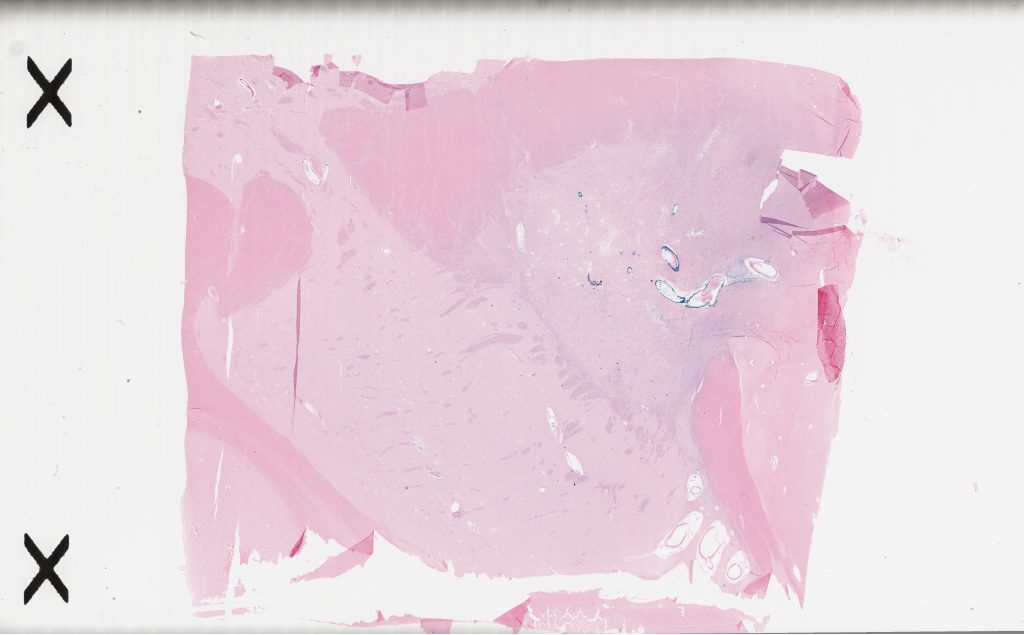 Digital Slide Viewer: neuropathology\Vascular