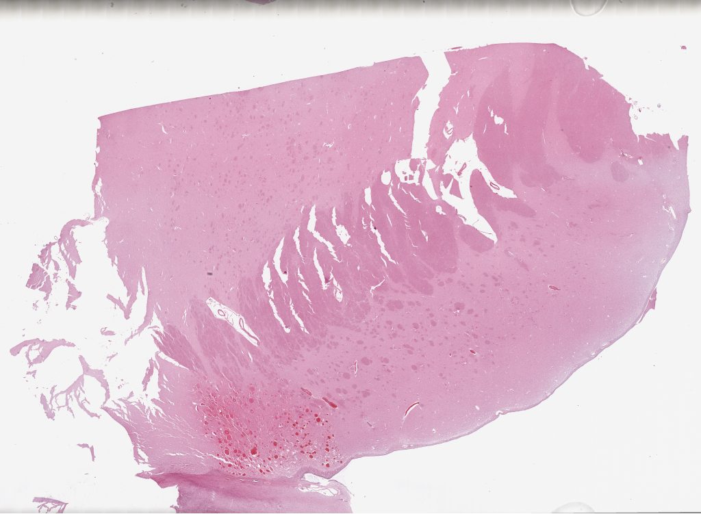 Digital Slide Viewer: neuropathology\Vascular
