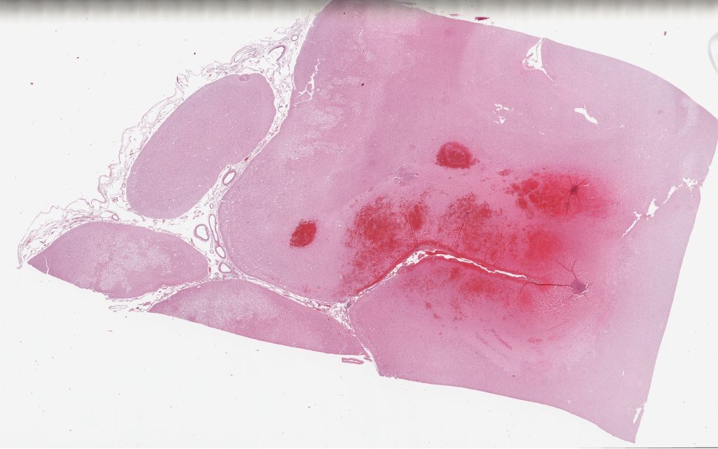 Digital Slide Viewer: neuropathology\Vascular