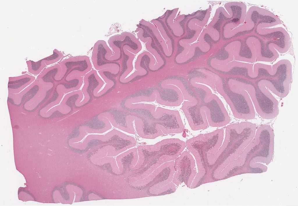 Digital Slide Viewer: neuropathology\Vascular