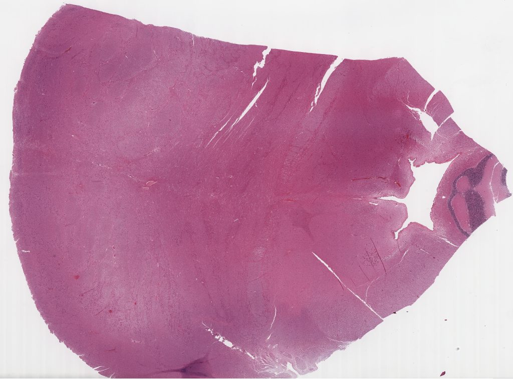 Digital Slide Viewer: neuropathology\Vascular
