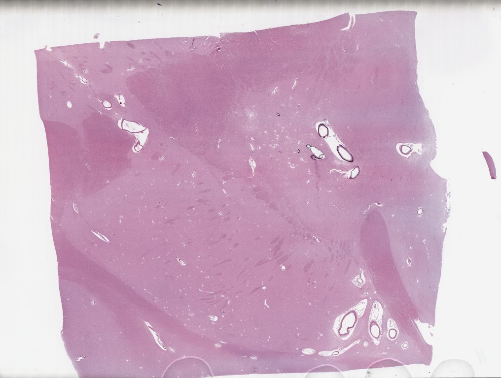Digital Slide Viewer: neuropathology\Vascular