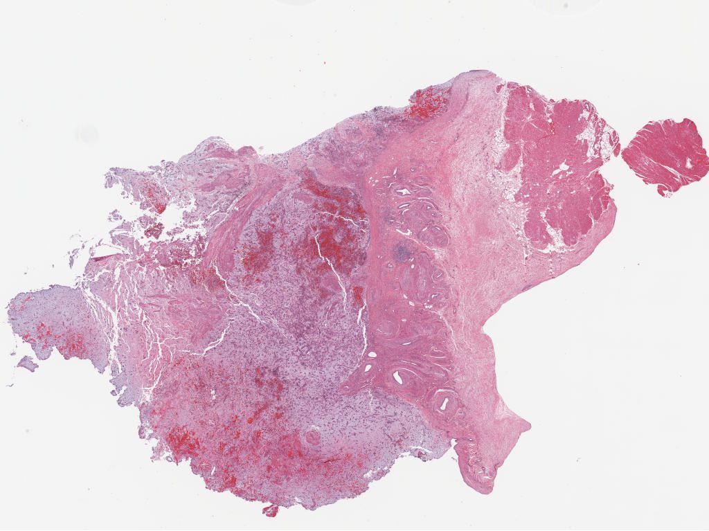 Digital Slide Viewer: upmc-pathology-center-of-excellence\Autopsy