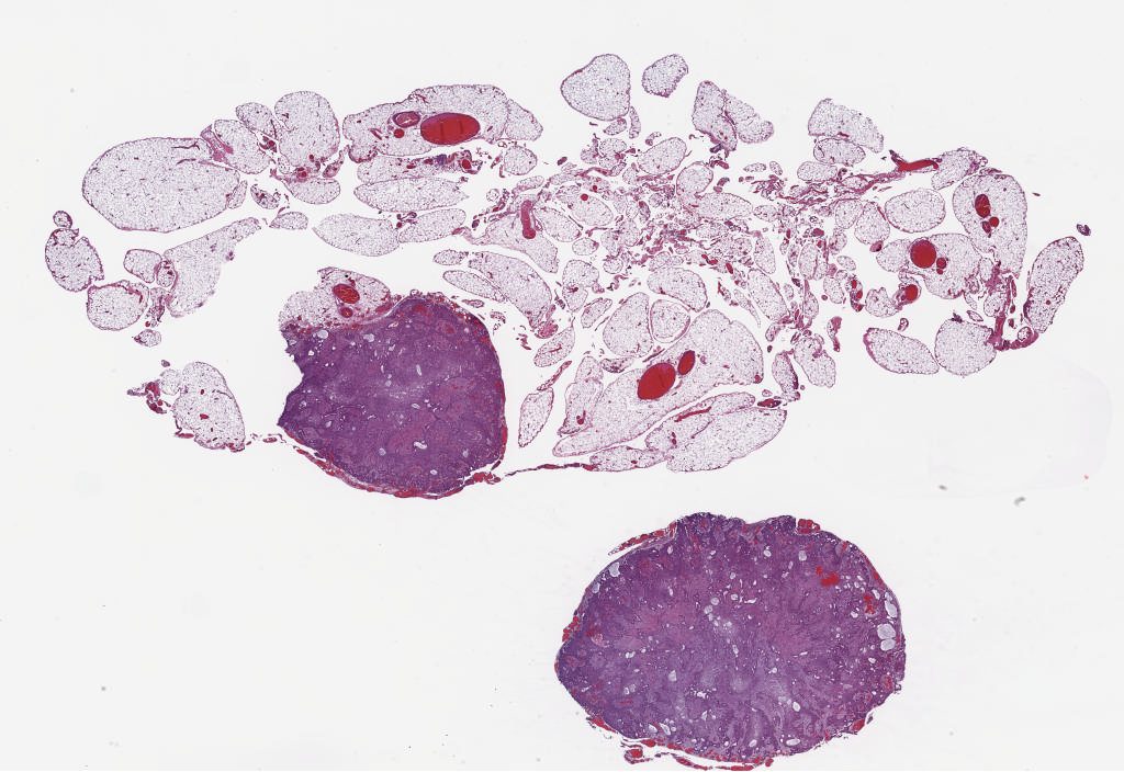 Digital Slide Viewer: upmc-pathology-center-of-excellence\GI