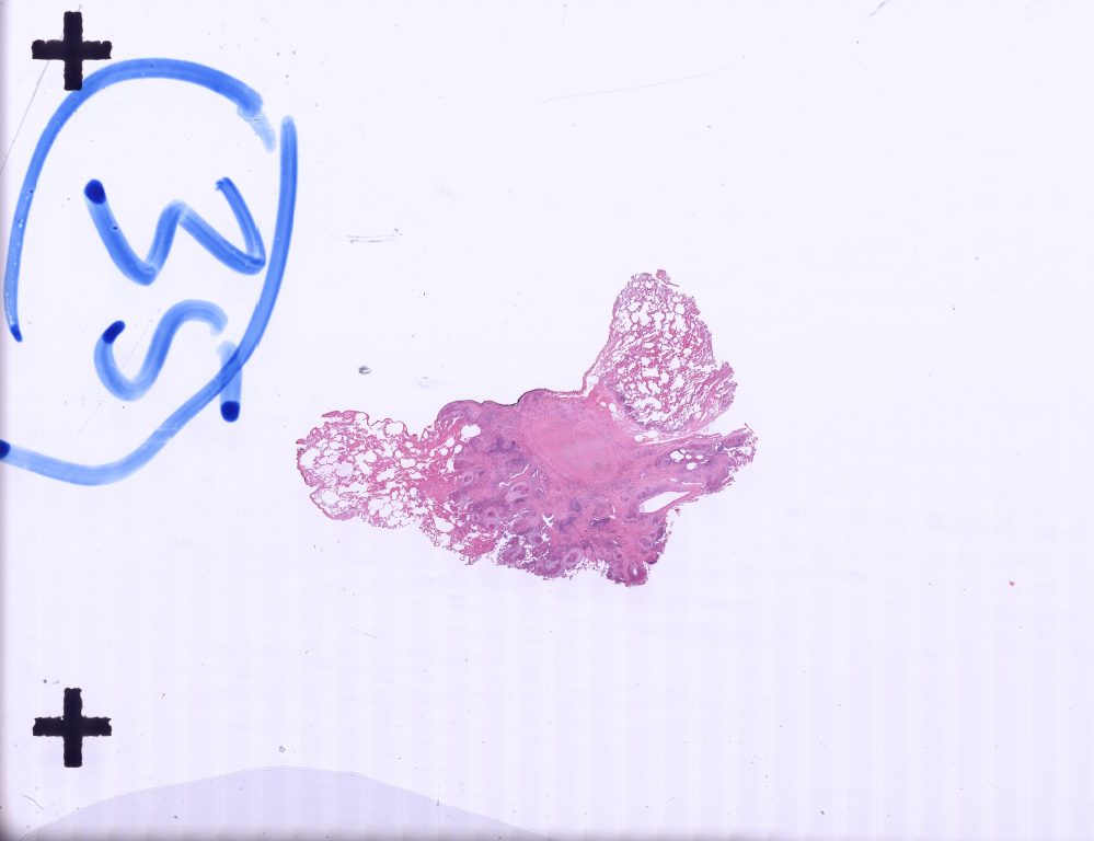 Digital Slide Viewer: upmc-pathology-center-of-excellence\thoracic\Set1