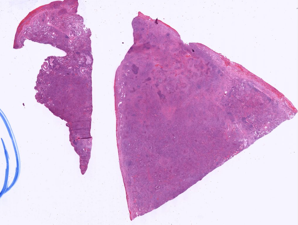 Digital Slide Viewer: upmc-pathology-center-of-excellence\thoracic\Set1