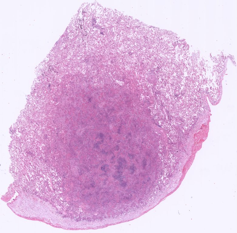 Digital Slide Viewer: upmc-pathology-center-of-excellence\thoracic\Set1