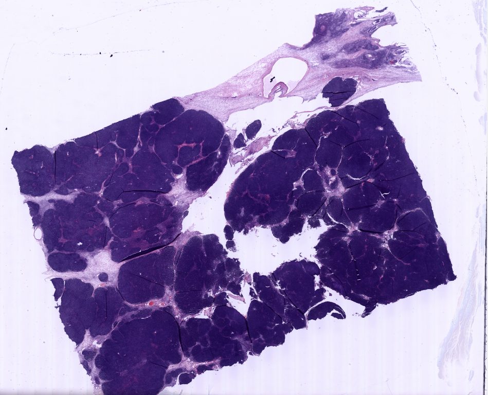 Digital Slide Viewer: upmc-pathology-center-of-excellence\thoracic\Set1
