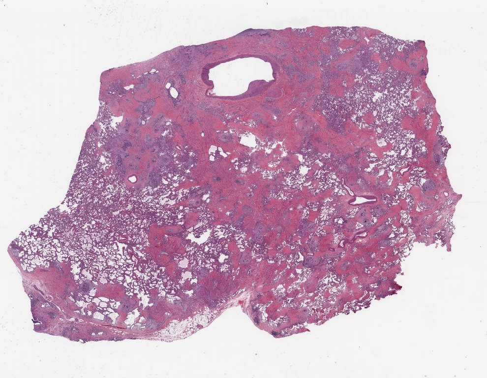 Digital Slide Viewer: upmc-pathology-center-of-excellence\thoracic\Set15
