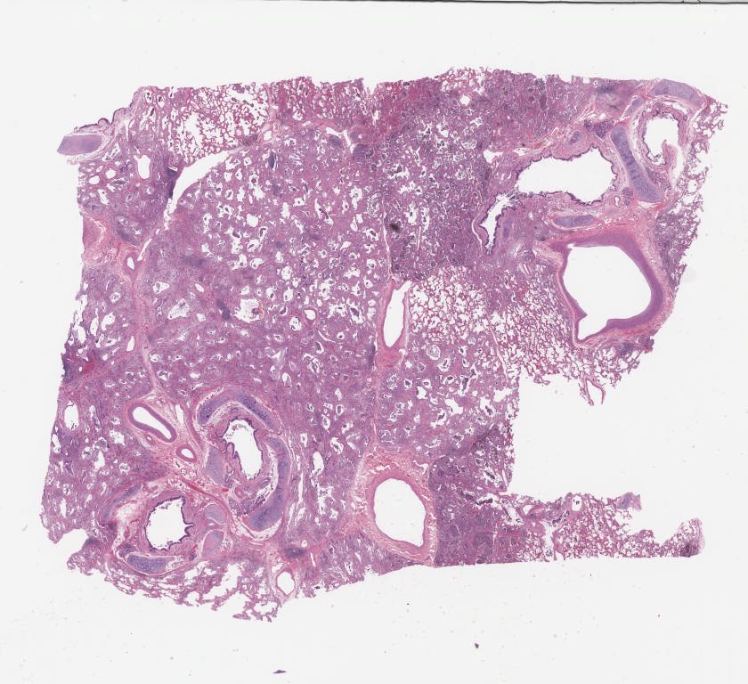 Digital Slide Viewer: upmc-pathology-center-of-excellence\thoracic\Set15