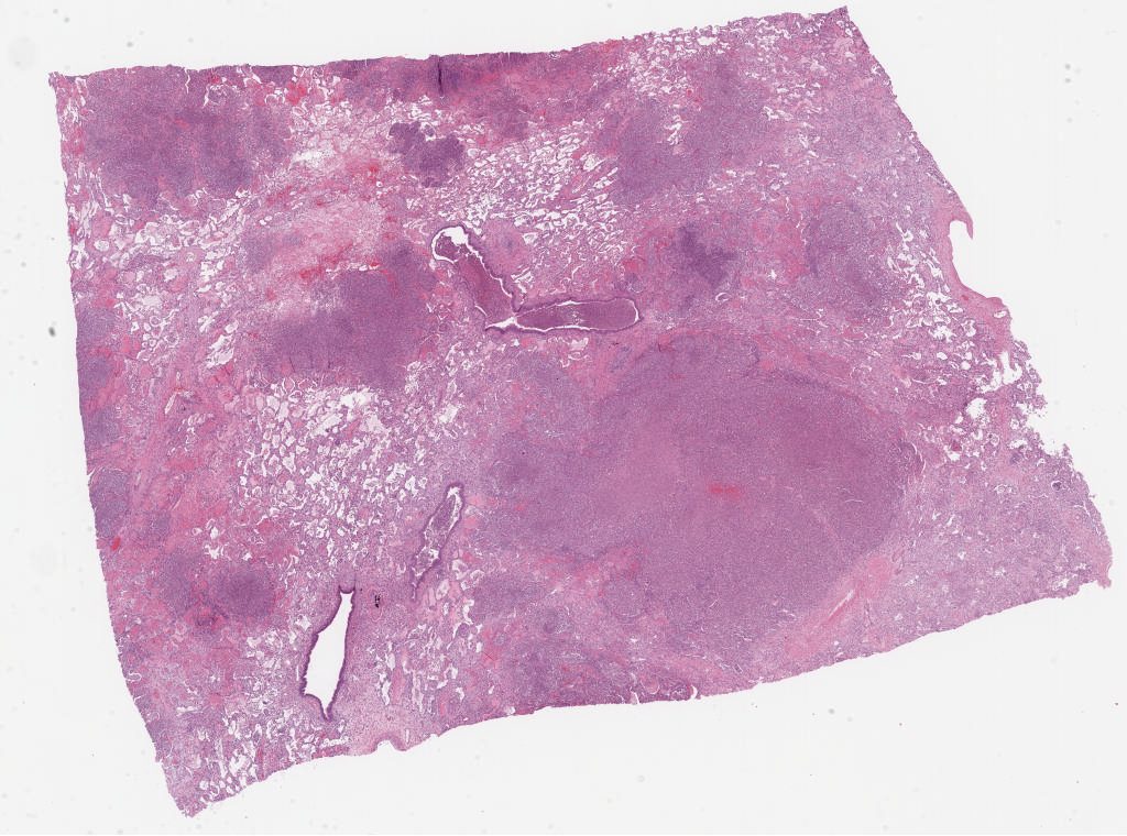 Digital Slide Viewer: upmc-pathology-center-of-excellence\thoracic\Set15