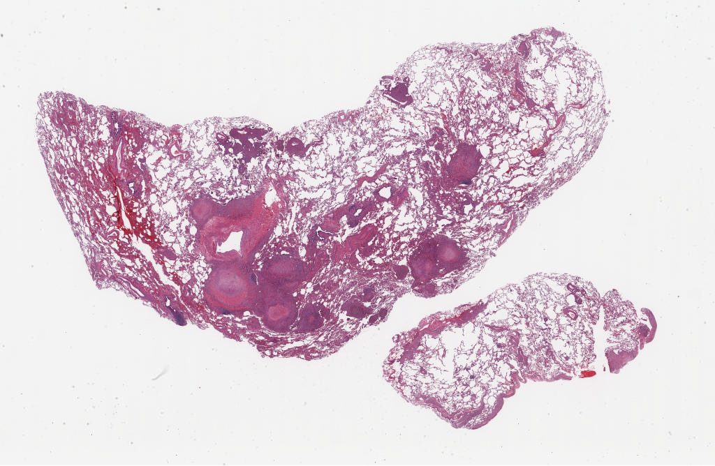 Digital Slide Viewer: upmc-pathology-center-of-excellence\thoracic\Set15