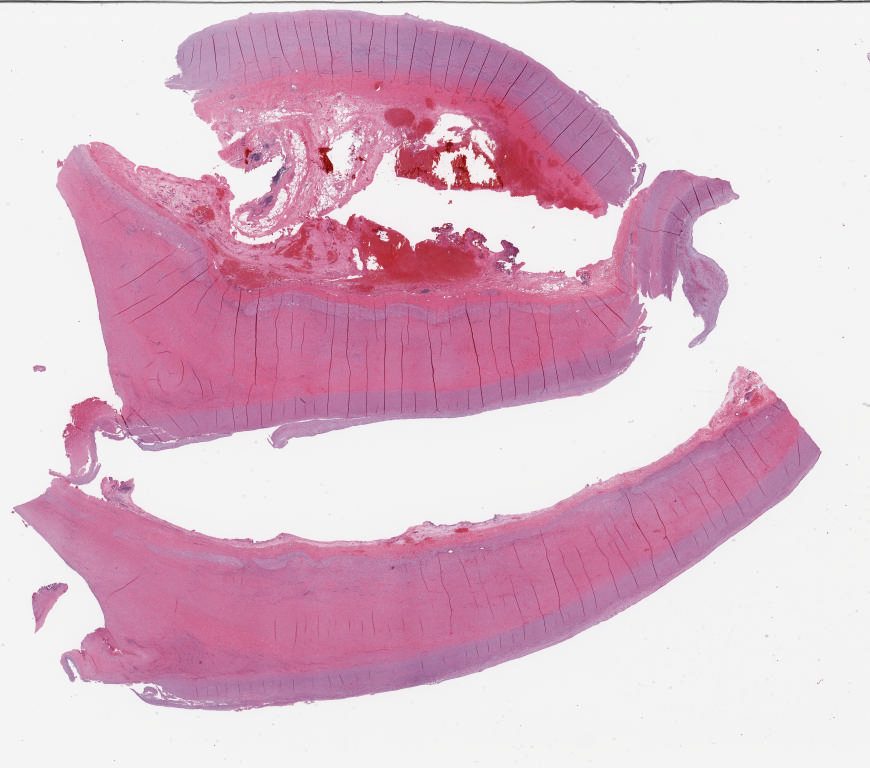 Digital Slide Viewer: upmc-pathology-center-of-excellence\thoracic\Set15