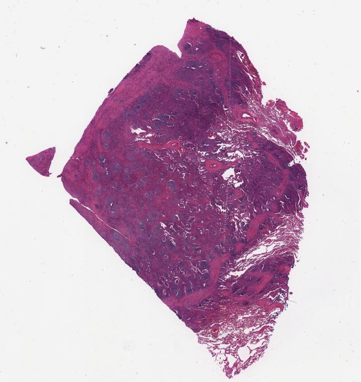 Digital Slide Viewer: upmc-pathology-center-of-excellence\thoracic\Set16