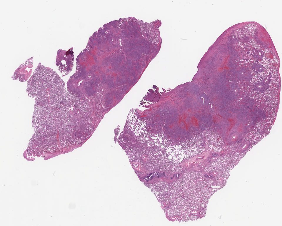 Digital Slide Viewer: upmc-pathology-center-of-excellence\thoracic\Set16