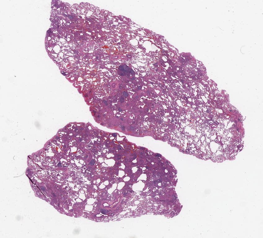 Digital Slide Viewer: upmc-pathology-center-of-excellence\thoracic\Set16