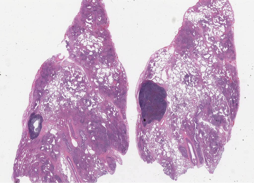 Digital Slide Viewer: upmc-pathology-center-of-excellence\thoracic\Set16