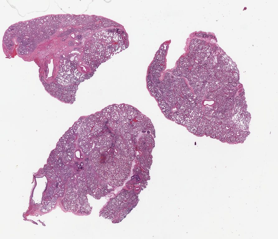 Digital Slide Viewer: upmc-pathology-center-of-excellence\thoracic\Set17