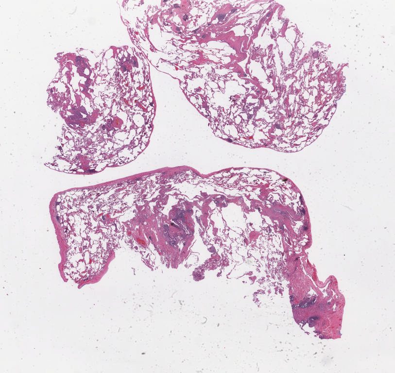 Digital Slide Viewer: upmc-pathology-center-of-excellence\thoracic\Set17