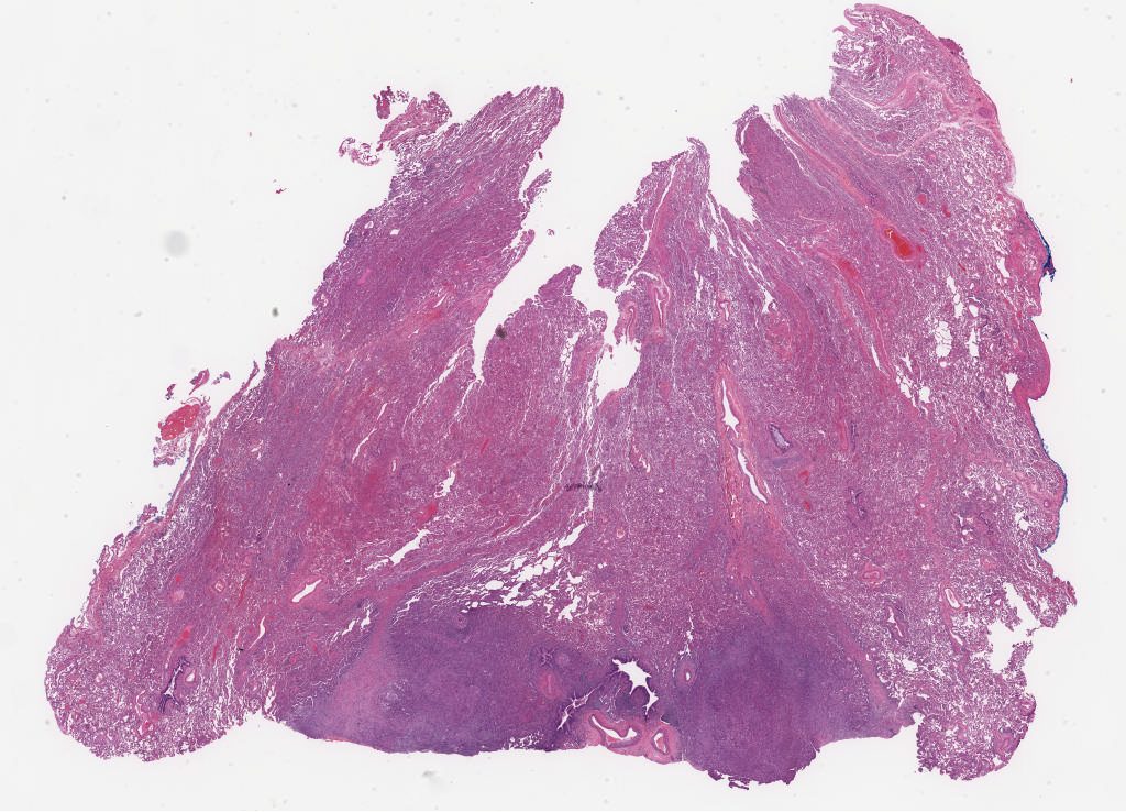 Digital Slide Viewer: upmc-pathology-center-of-excellence\thoracic\Set17