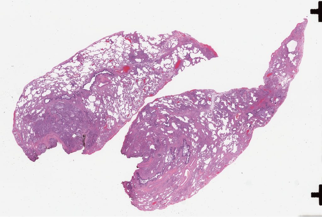 Digital Slide Viewer: upmc-pathology-center-of-excellence\thoracic\Set17