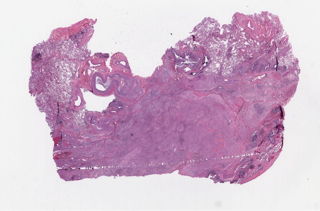 Digital Slide Viewer: upmc-pathology-center-of-excellence\thoracic\Set17