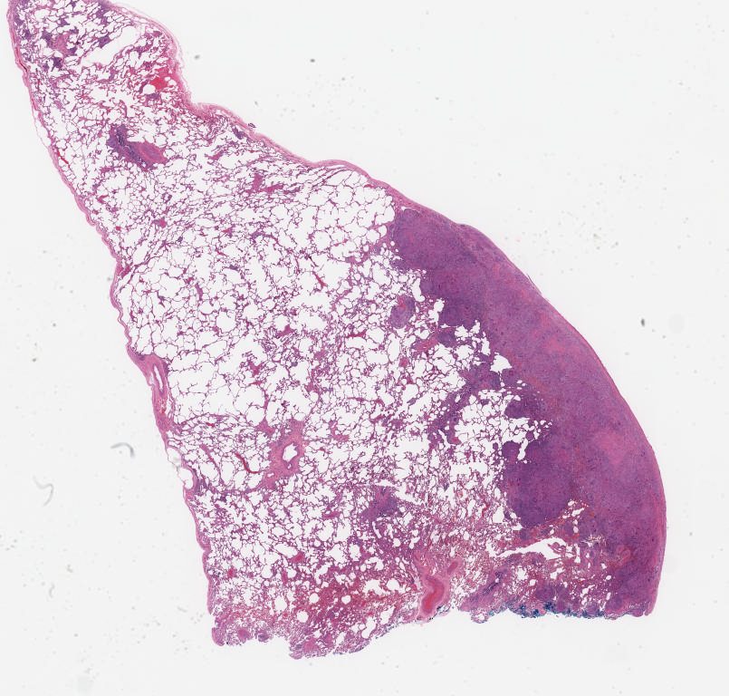 Digital Slide Viewer: upmc-pathology-center-of-excellence\thoracic\Set17