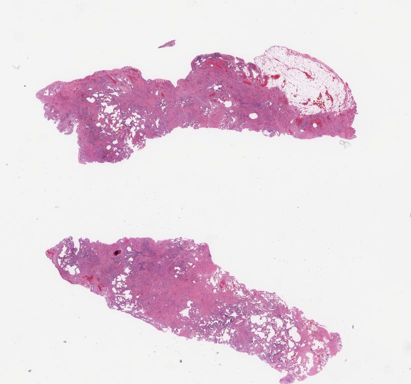 Digital Slide Viewer: upmc-pathology-center-of-excellence\thoracic\Set17