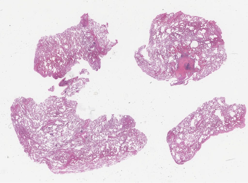 Digital Slide Viewer: upmc-pathology-center-of-excellence\thoracic\Set17