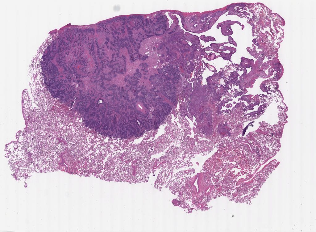 Digital Slide Viewer: upmc-pathology-center-of-excellence\thoracic\Set17