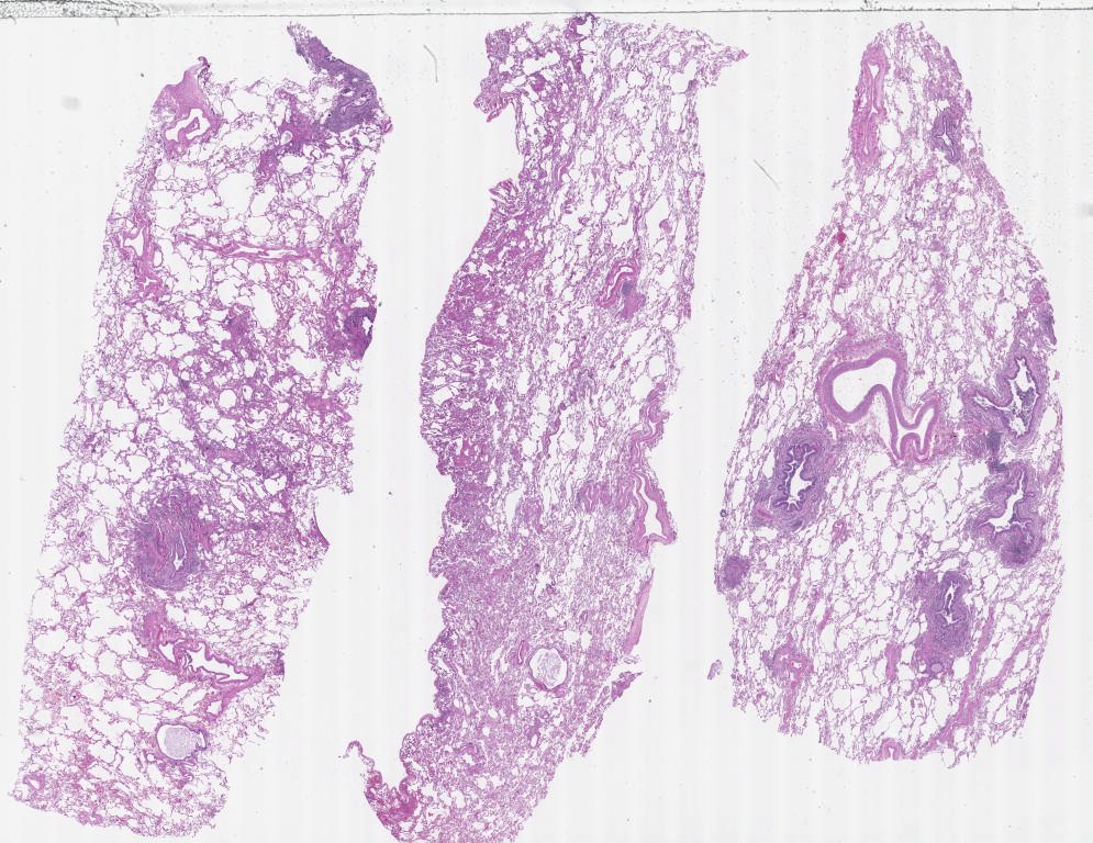 Digital Slide Viewer: upmc-pathology-center-of-excellence\thoracic\Set19
