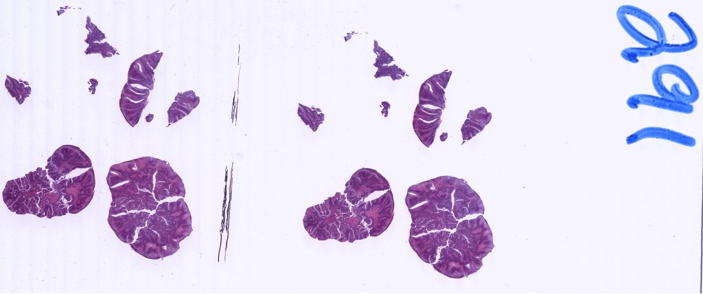 Digital Slide Viewer: upmc-pathology-center-of-excellence\thoracic\Set4