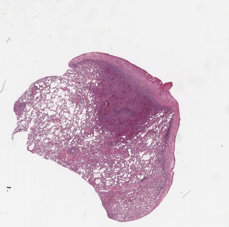 Digital Slide Viewer: upmc-pathology-center-of-excellence\thoracic\Set7