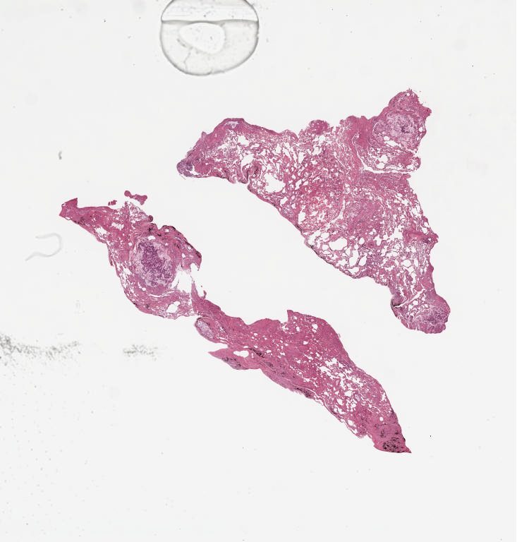 Digital Slide Viewer: upmc-pathology-center-of-excellence\thoracic\Set7