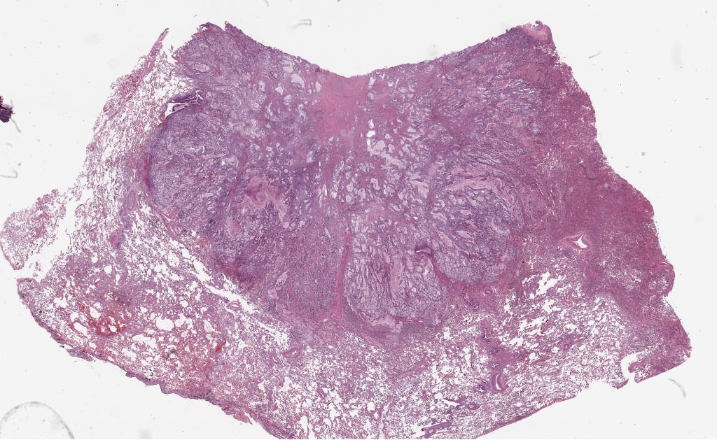 Digital Slide Viewer: upmc-pathology-center-of-excellence\thoracic\Set7