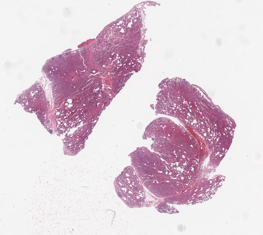 Digital Slide Viewer: upmc-pathology-center-of-excellence\thoracic\Set9