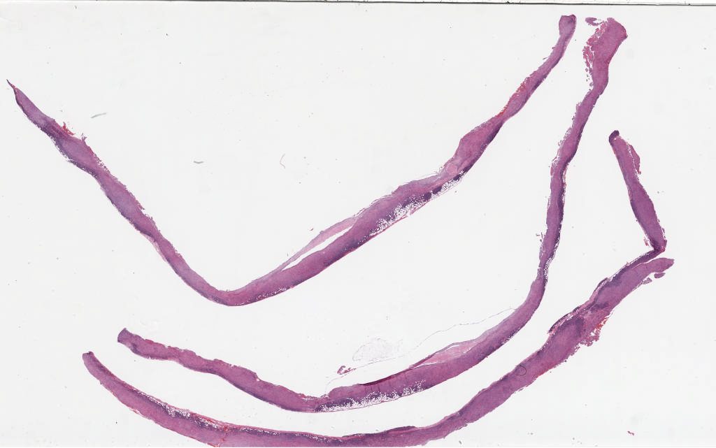Digital Slide Viewer: upmc-pathology-center-of-excellence\thoracic\Set9