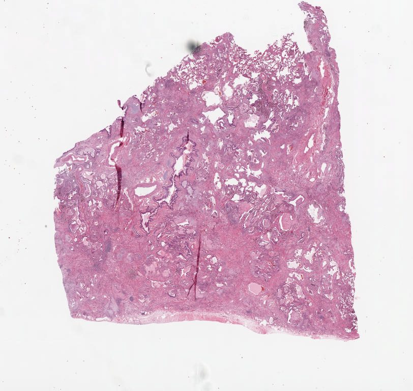 Digital Slide Viewer: upmc-pathology-center-of-excellence\thoracic\Set9