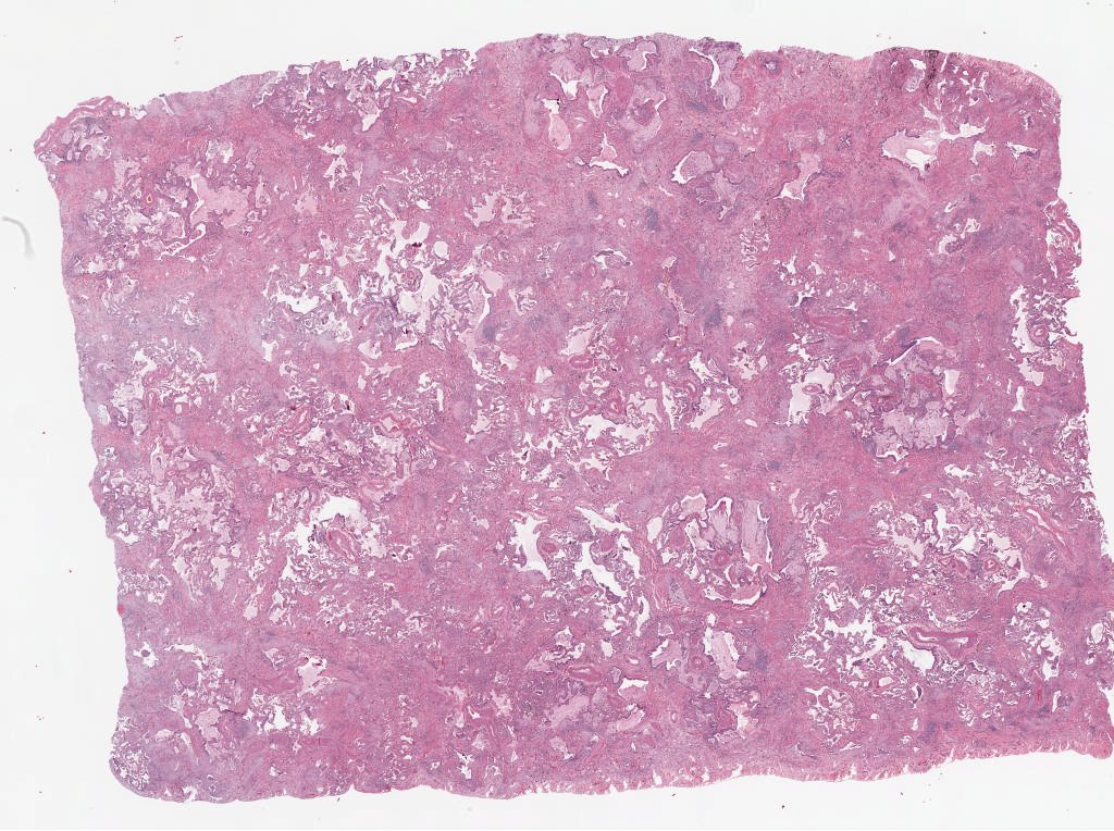 Digital Slide Viewer: upmc-pathology-center-of-excellence\thoracic\Set9