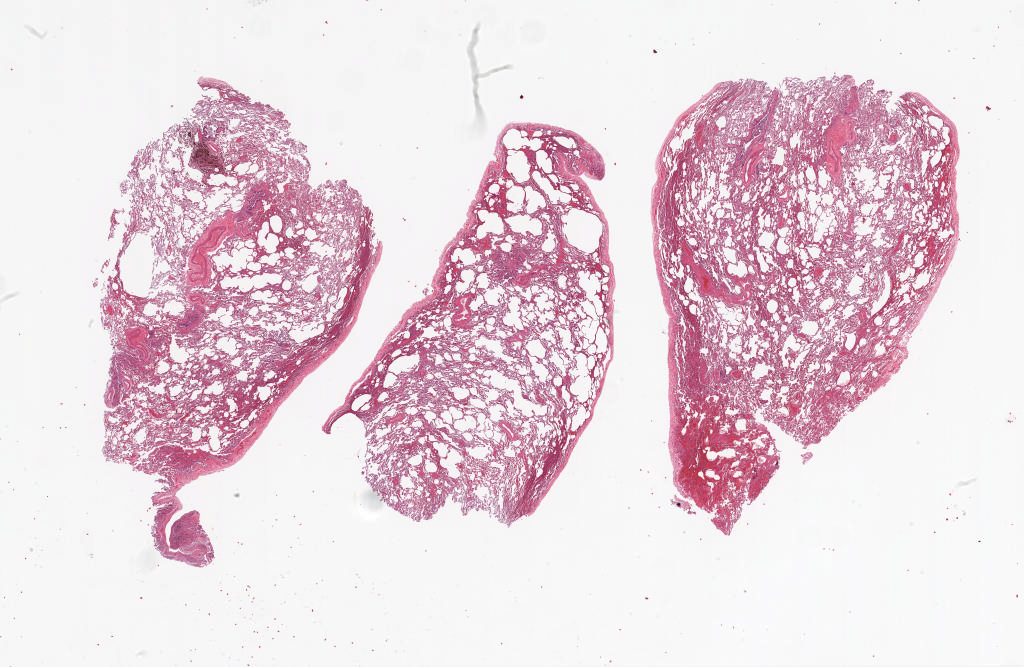 Digital Slide Viewer: upmc-pathology-center-of-excellence\thoracic\Set9