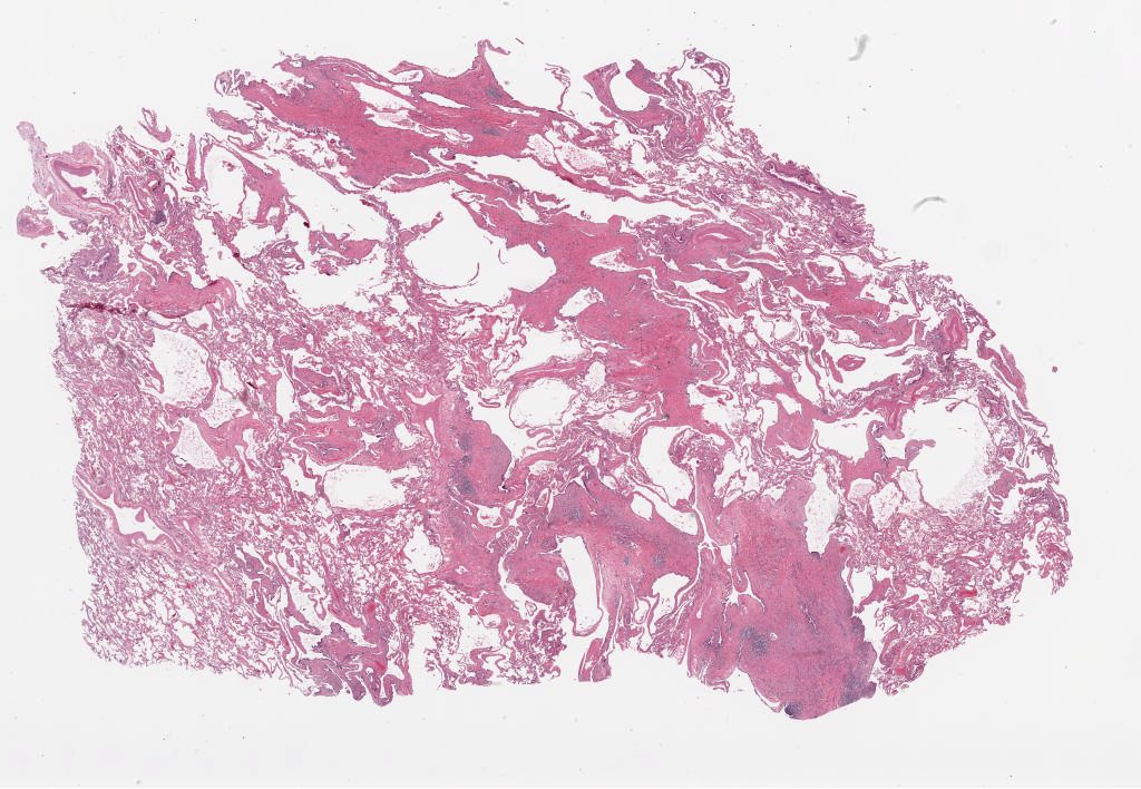 Digital Slide Viewer: upmc-pathology-center-of-excellence\thoracic\Set9