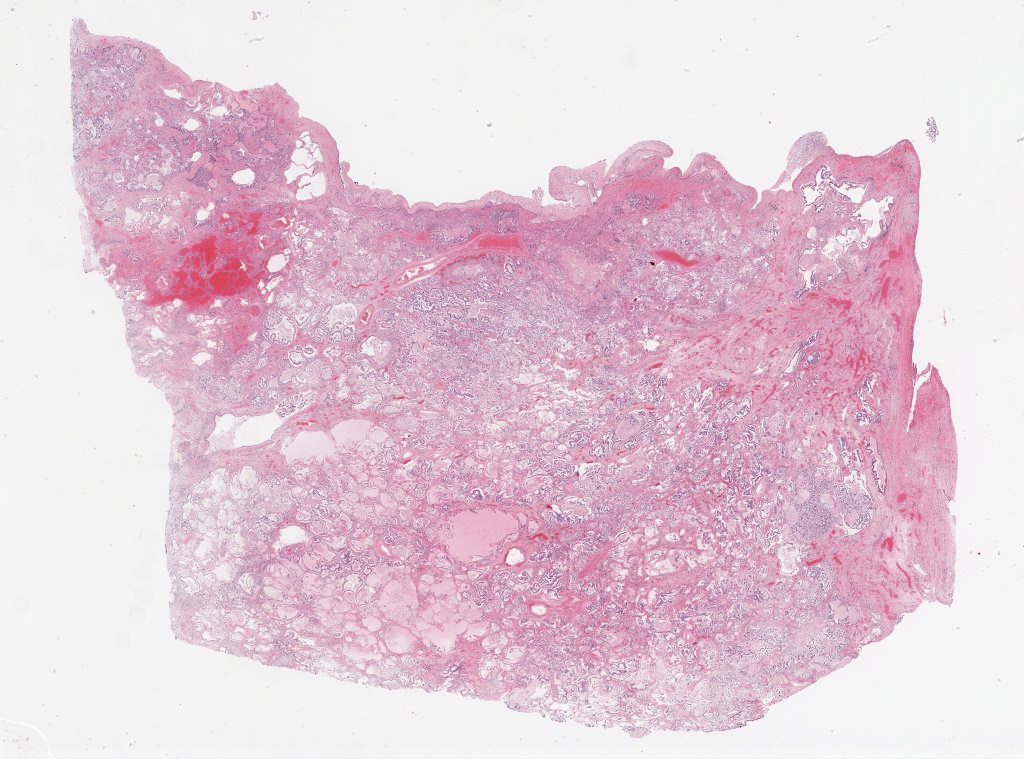 Digital Slide Viewer: upmc-pathology-center-of-excellence\thoracic\Set9