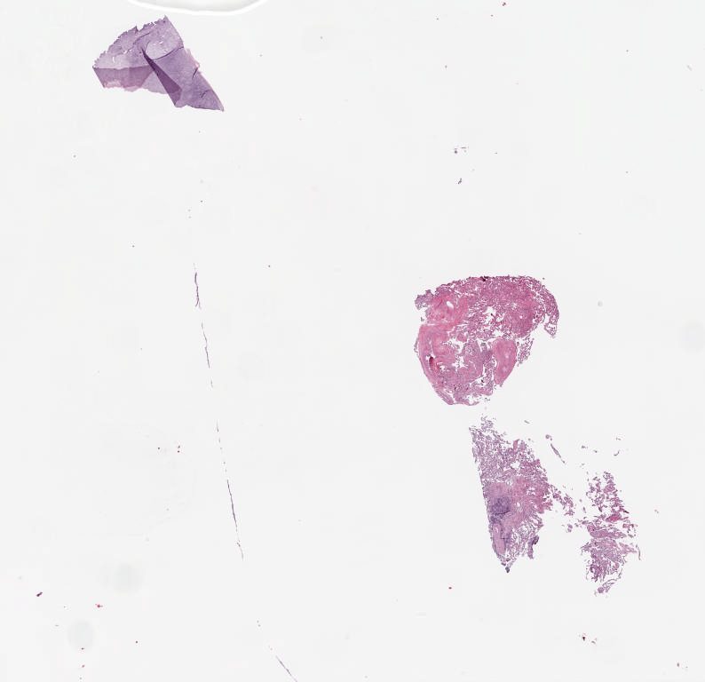 Digital Slide Viewer: upmc-pathology-center-of-excellence\thoracic\Set9