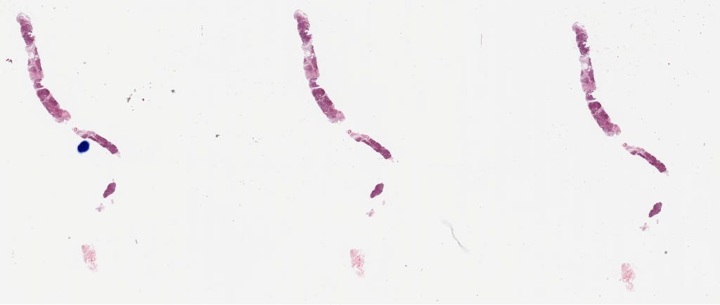 Digital Slide Viewer: upmc-pathology-center-of-excellence\transplant ...